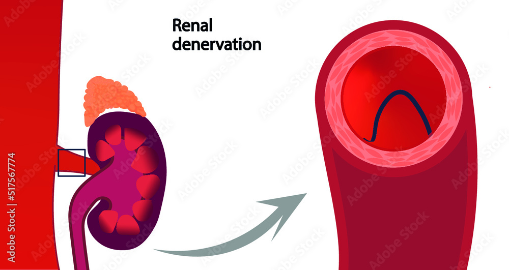 Vektorová grafika „Renal denervation illustration. RDN treatment for ...
