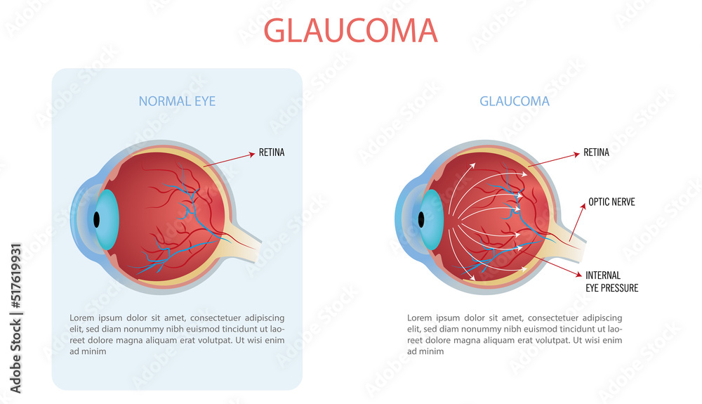Infographic of a normal eye and an eye with glaucoma, the arrows ...