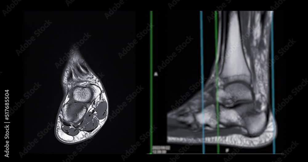 mri ankle joint coronal and sagittal T2 for diagnosis tendon of ankle ...