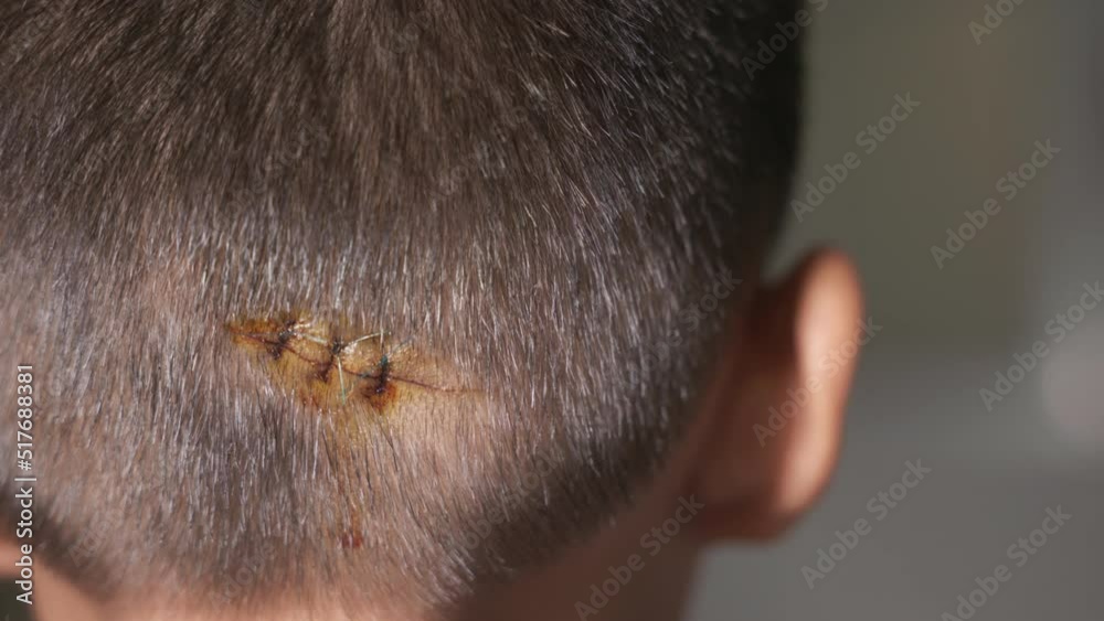 The lacerated sutured wound of kid back head which suture by nylon ...