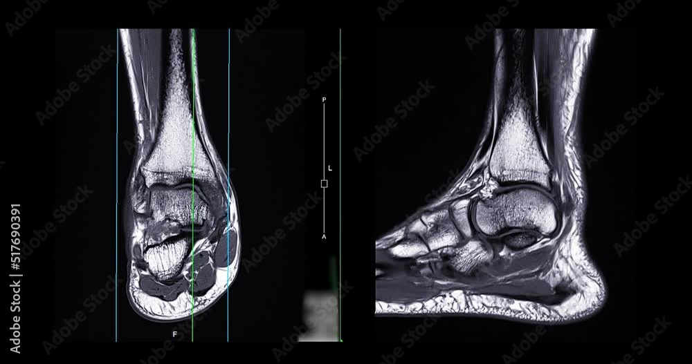 mri ankle joint coronal and sagittal T2 for diagnosis tendon of ankle ...
