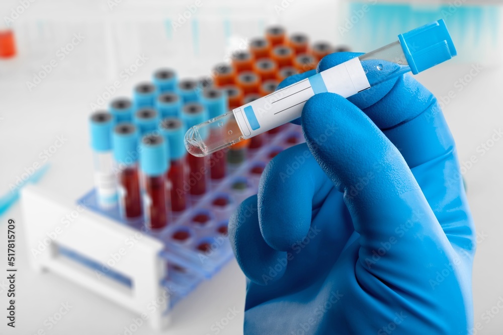 Blood sample of patient for complete screening test in laboratory ...