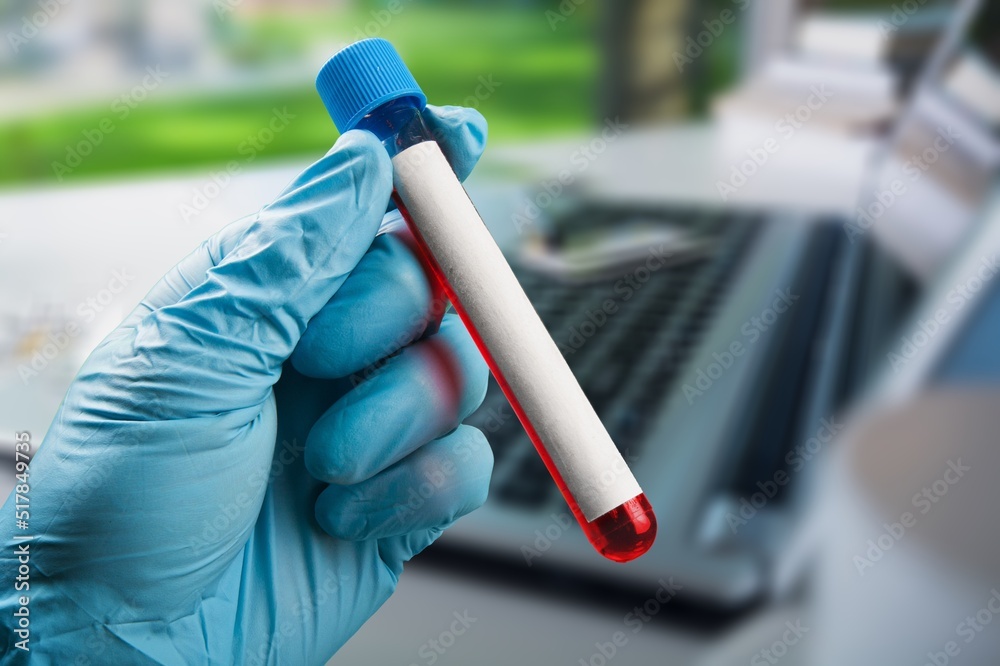 Blood sample tube for virus test. It is also known as the Moneypox ...