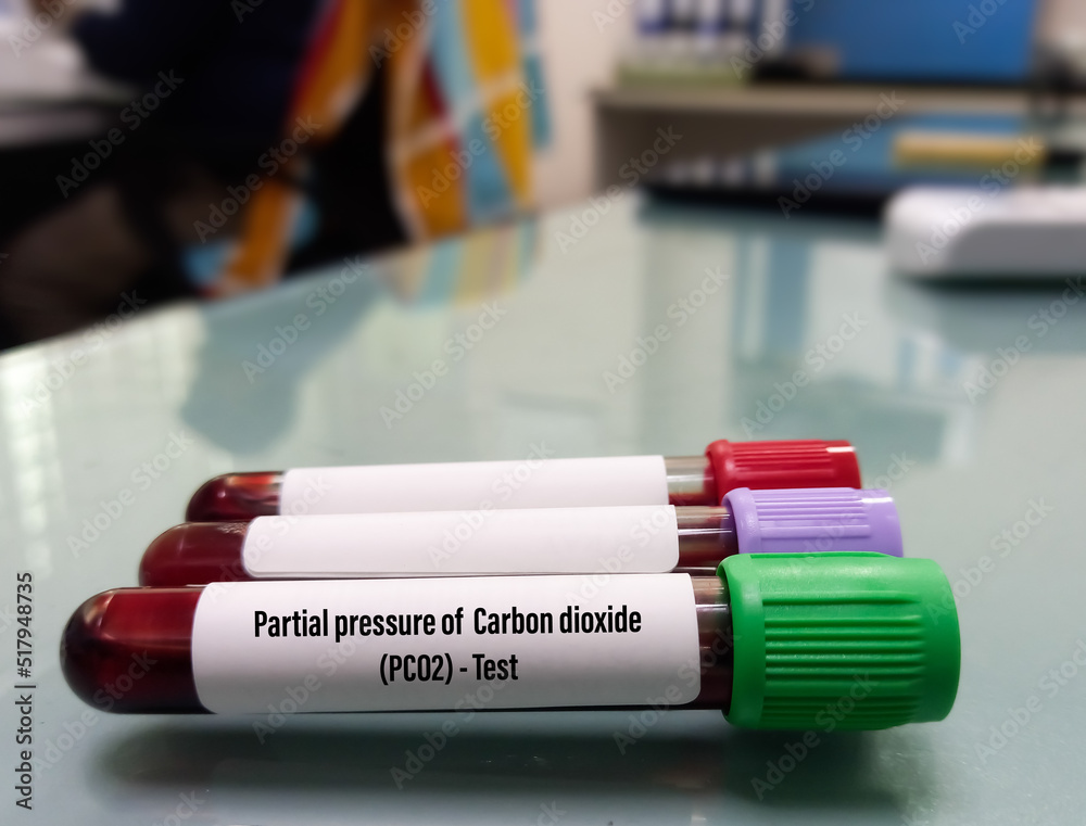 Blood sample for Partial pressure of carbon dioxide(PCO2) test, as a ...