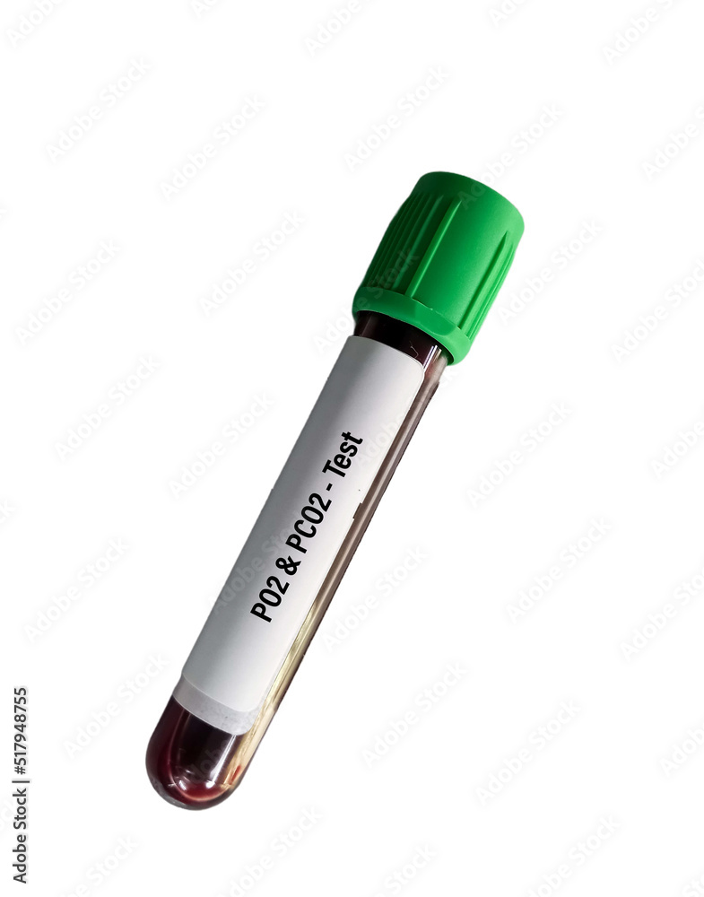 Blood sample for PO2(partial pressure of oxygen) and PCO2(partial ...