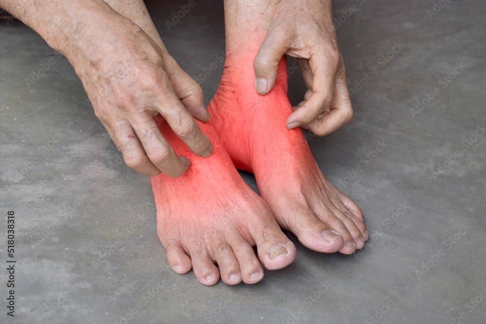 Asian man scratching his foot. Concept of itchy skin diseases such as ...