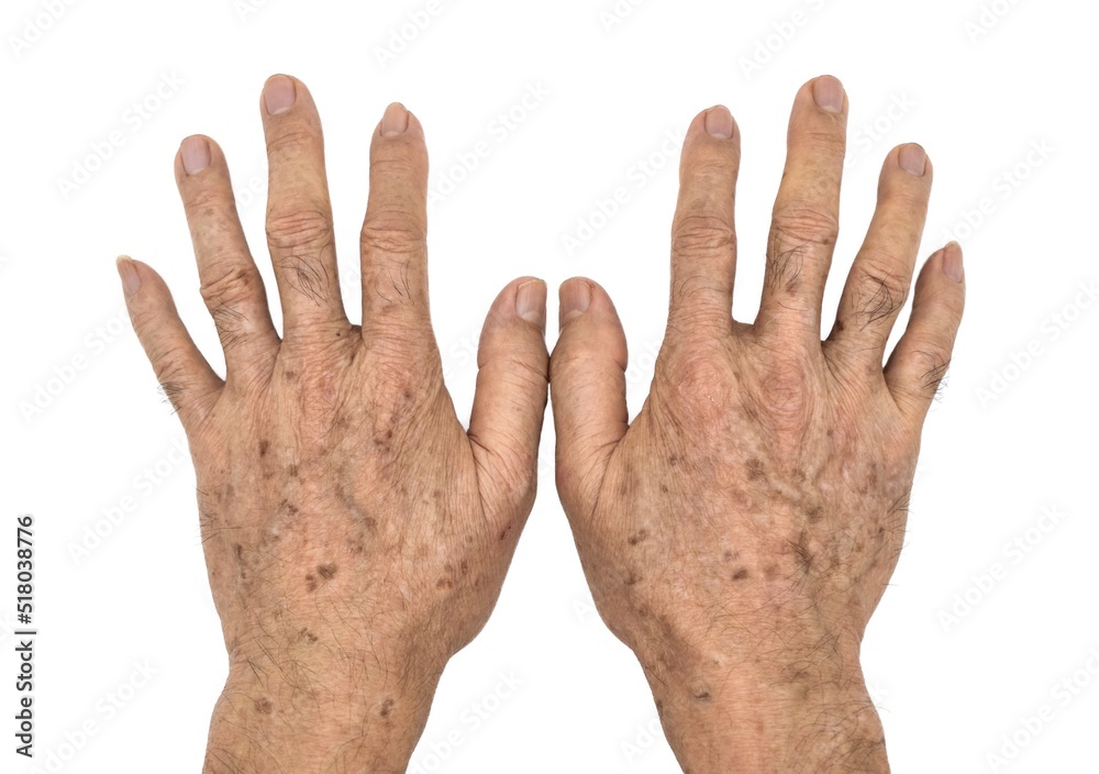 Age spots on hands of Asian man. They are brown, gray, or black spots ...