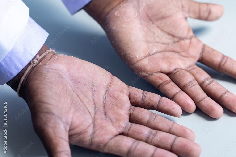 Pattern of Atopic eczema and fungal diseases on the human body. Stock ...