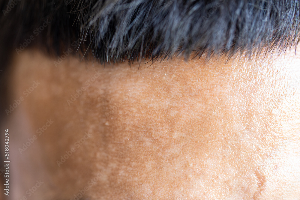 Poster Pattern of Atopic eczema and fungal diseases on the human body ...