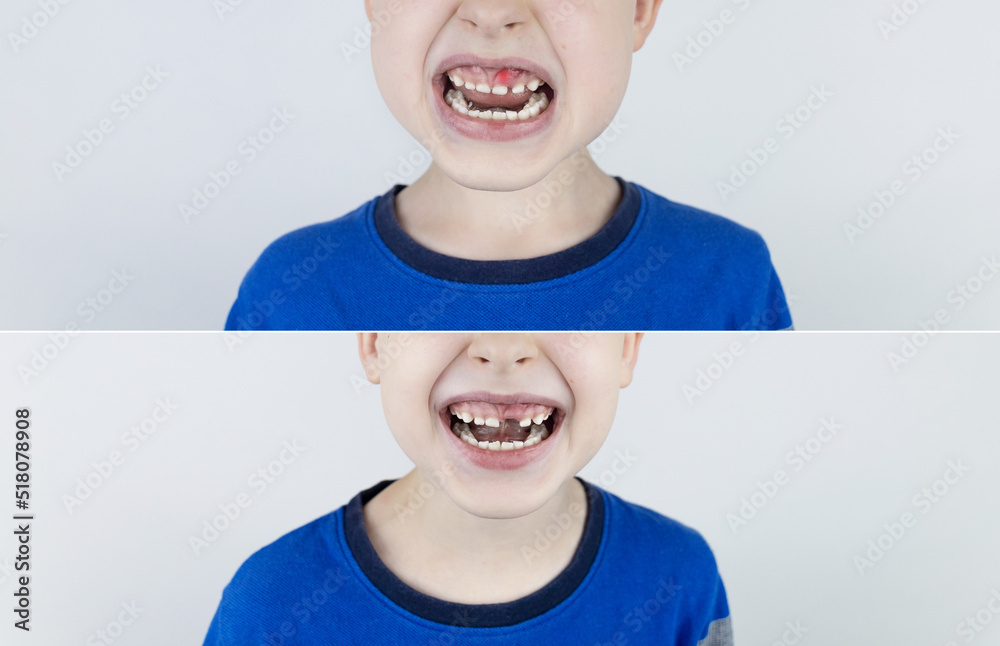 Before and after. Falling out milk tooth. Blond boy in photo has a ...