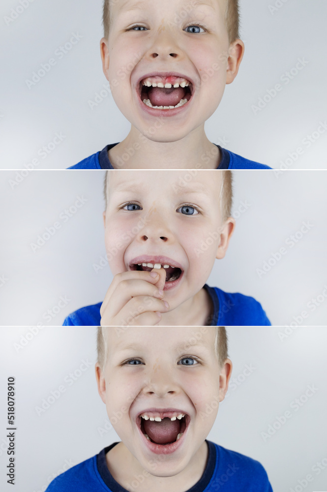 Before and after. Falling out milk tooth. Blond boy in photo has a ...