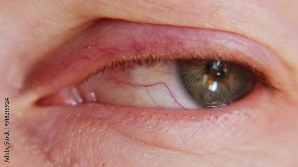 Extreme close-up inflamed vessels human eye. Blinking tired sick eye ...