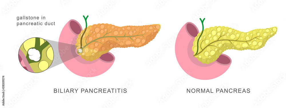 Acute pancreas inflamation caused by the obstruction of the pancreatic ...