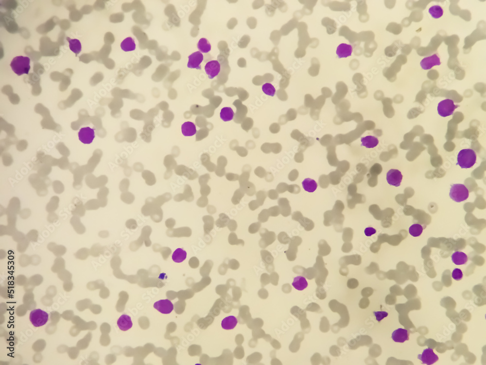 Chronic myeloid leukemia cells or CML, analyze by microscope, original ...