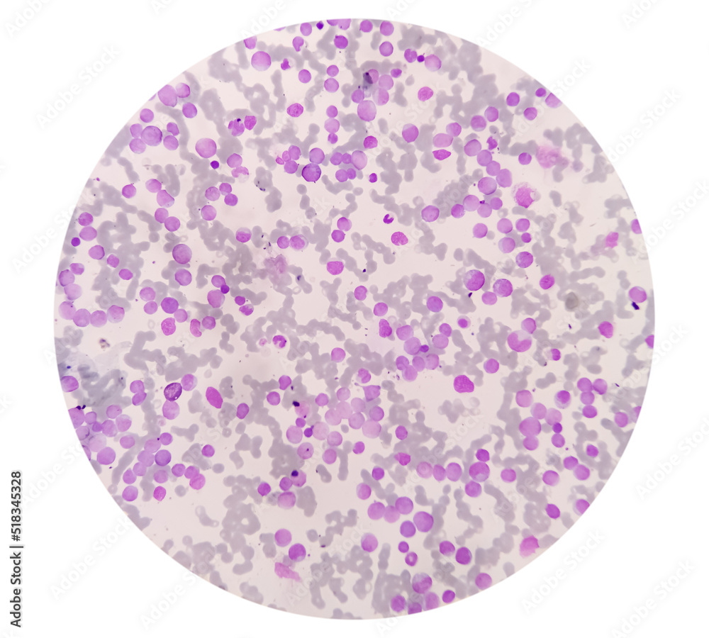 Foto de Chronic myeloid leukemia cells or CML, analyze by microscope ...