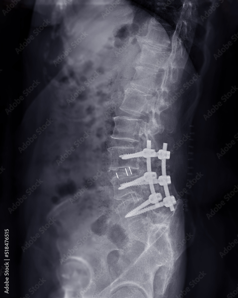 X-ray image of Lumbar spine with pedicle screw fixation. Stock Photo ...