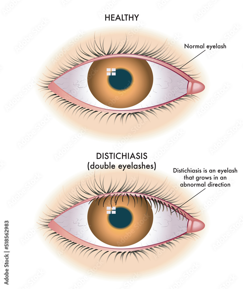 Medical illustration shows the comparison between a normal eye and one ...