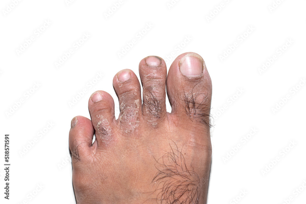 Image of a man's feet on a white background with fungal dermatitis on ...