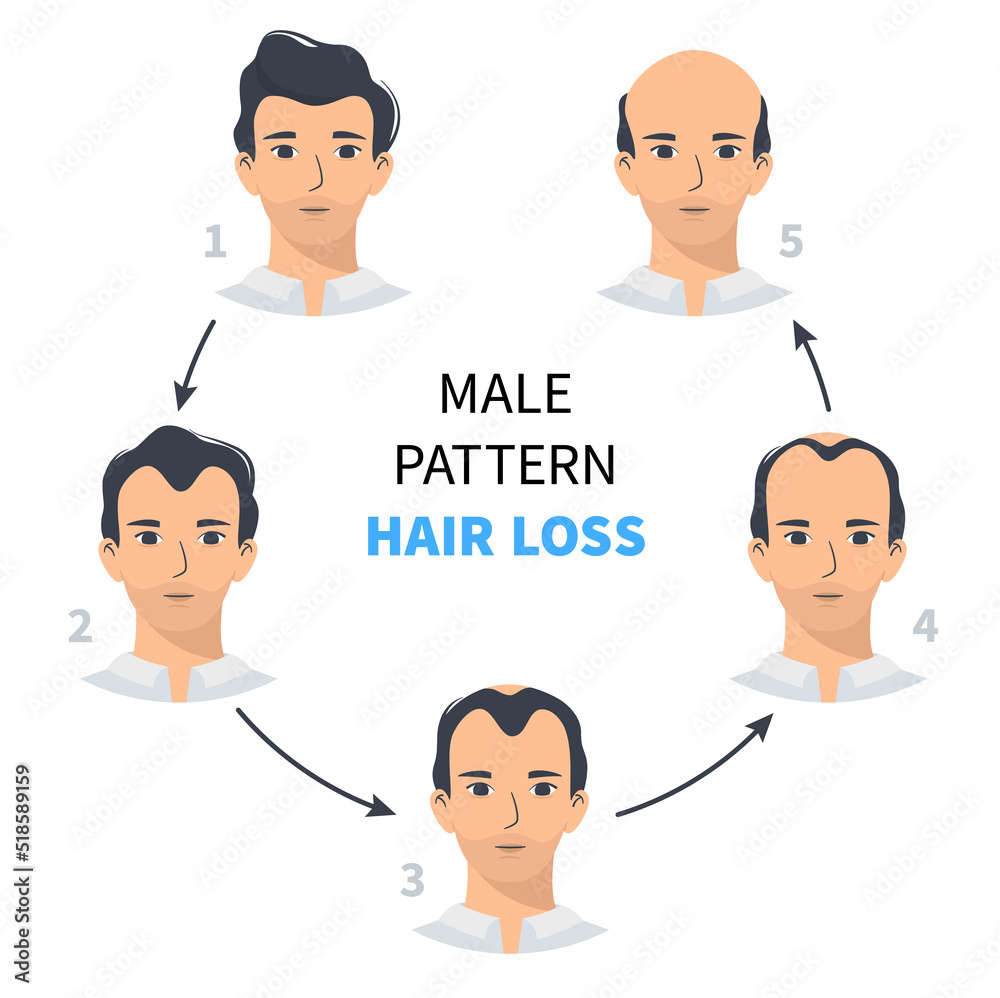 Hair loss stages, androgenetic alopecia male pattern. Steps of baldness vector infographic in a ...