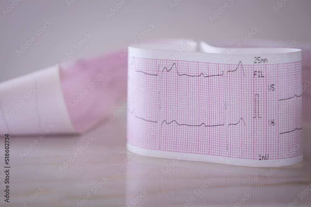 Tracing of an electrocardiogram with cardiac arrhythmia. Stock Photo ...