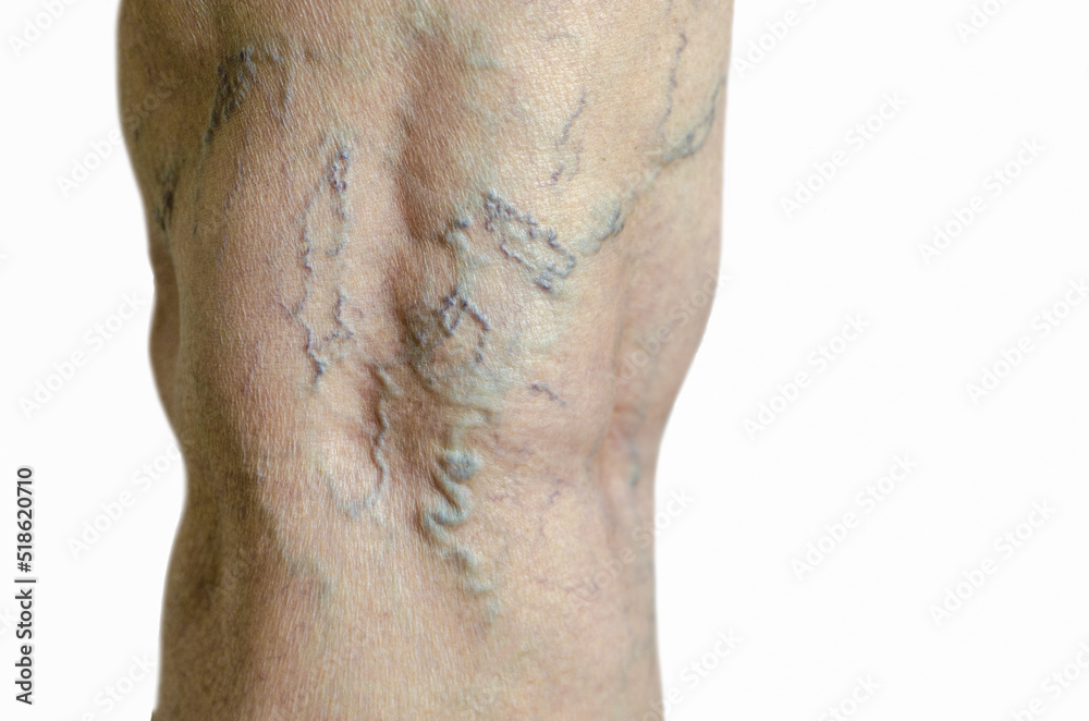 Older woman leg with varicose veins, deep vein thrombosis. Stock Photo ...