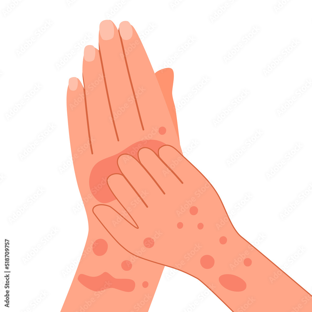 Itchy Clipart