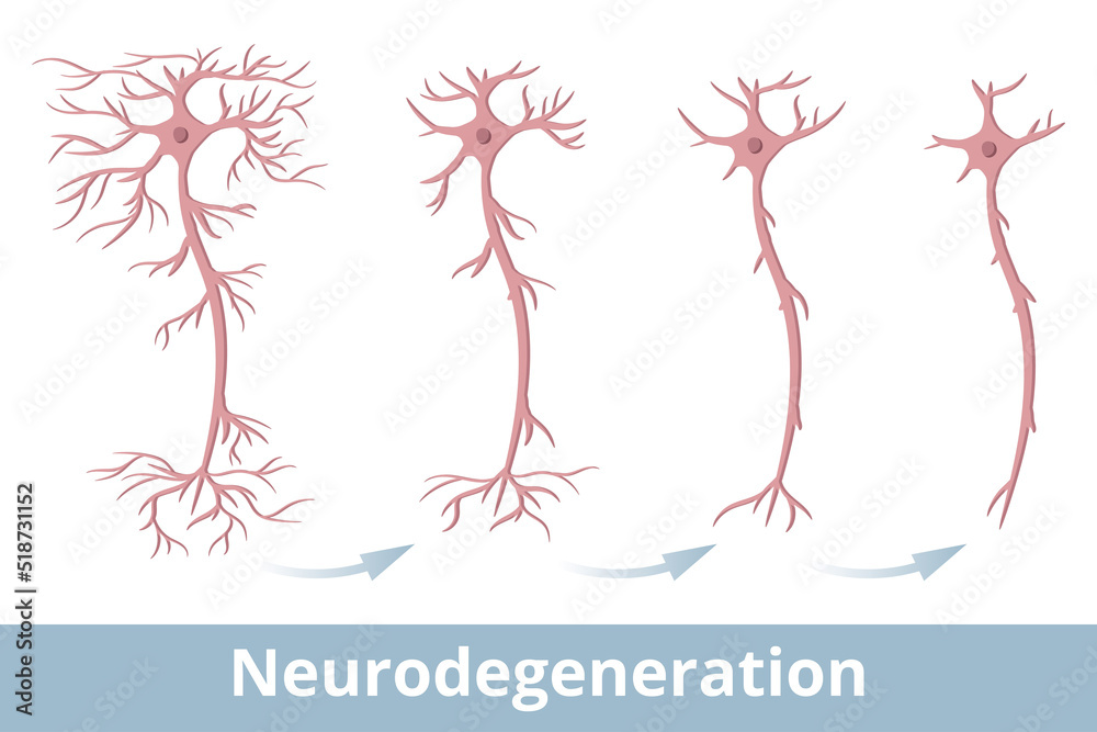 Neurodegeneration. Degeneration of a nerve cell, occurs because of ...