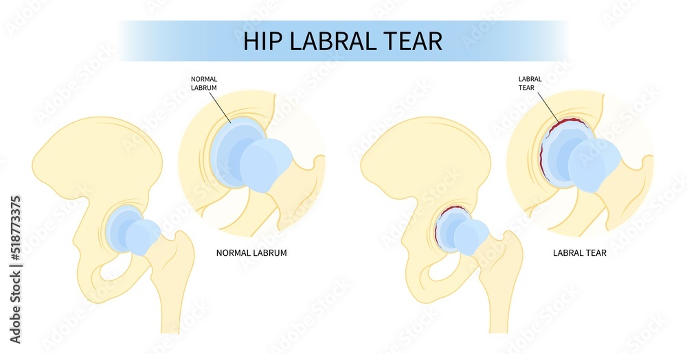 Labral cartilage of hip bone Pain and range of motion groin head tear ...
