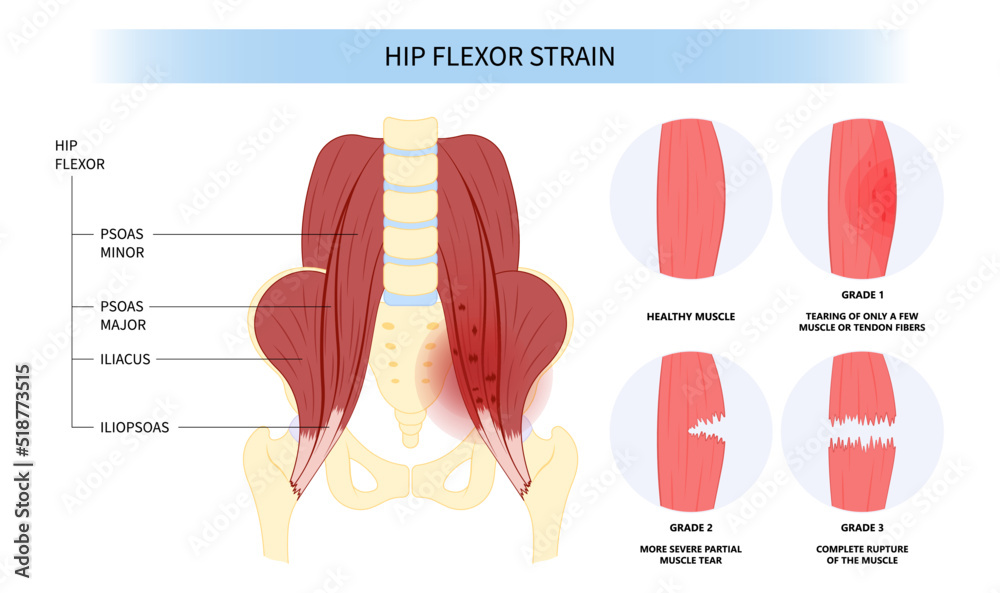 femur tendon Injury and trauma hip coxa saltans flexor stretch Pain ...