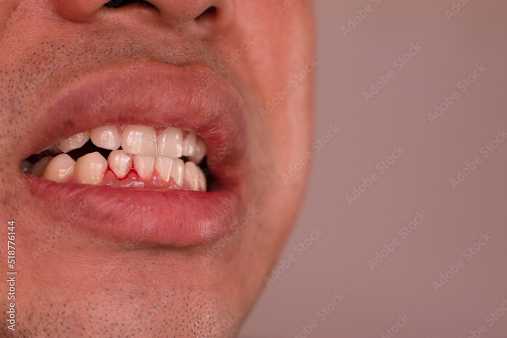 Close up of woman mouth with bleeding gums during teeth brushing ...