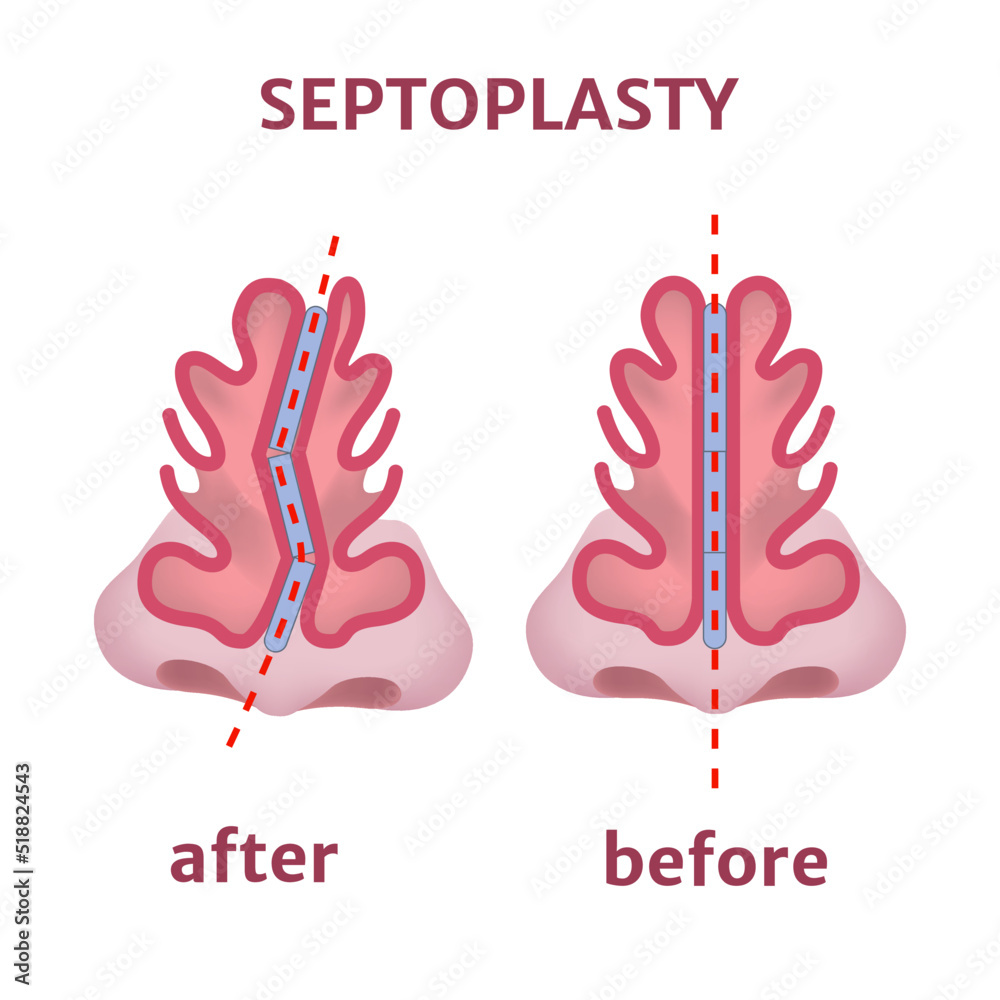 Septoplasty. Nose surgery. Curved cartilage. Medical poster. Vector ...