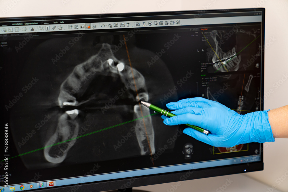Teeth dentistry x ray examination. Modern digital radiology for ...