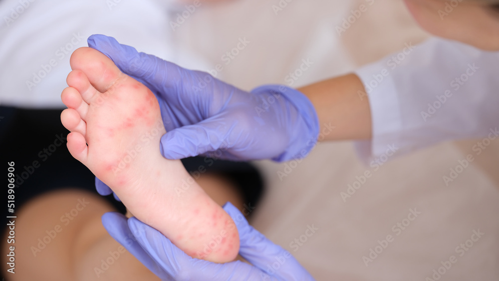 Rash with enterovirus infection of picornavirus family on feet of child ...