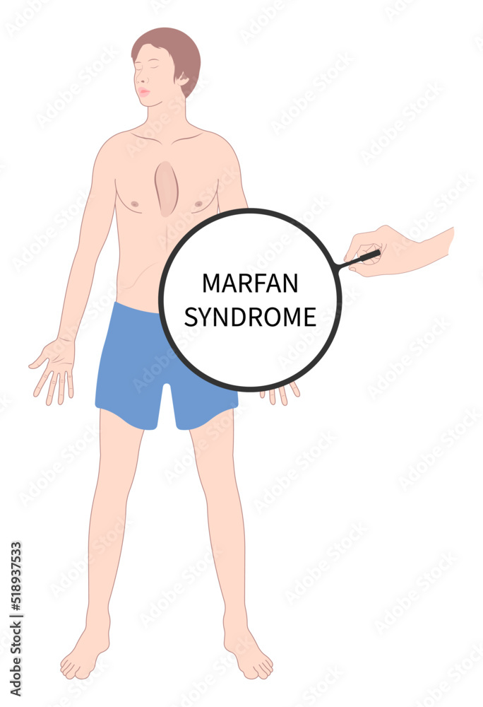 Marfan’s syndrome genetic condition disease with Enlarged Heart ...