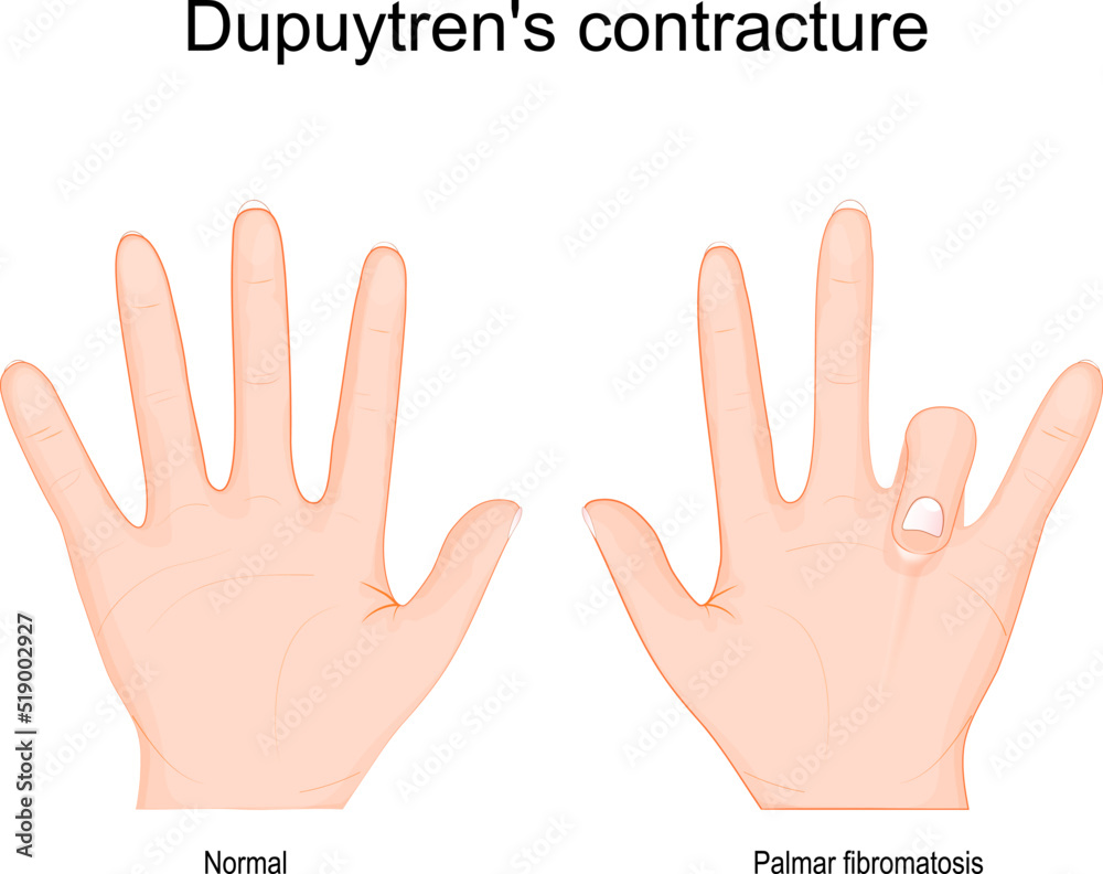 Dupuytren's contracture. Comparison and difference of a healthy hand ...