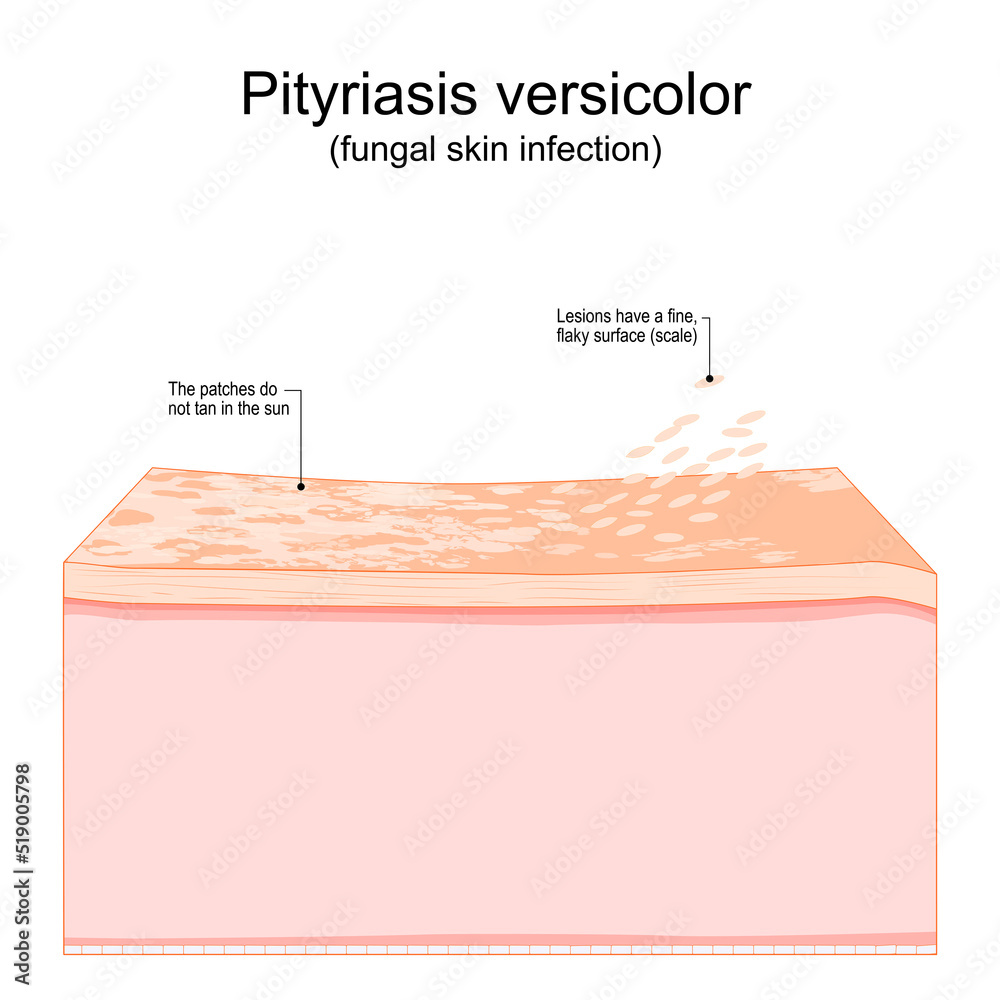 Pityriasis versicolor. fungal skin infection. Cross section of a human ...