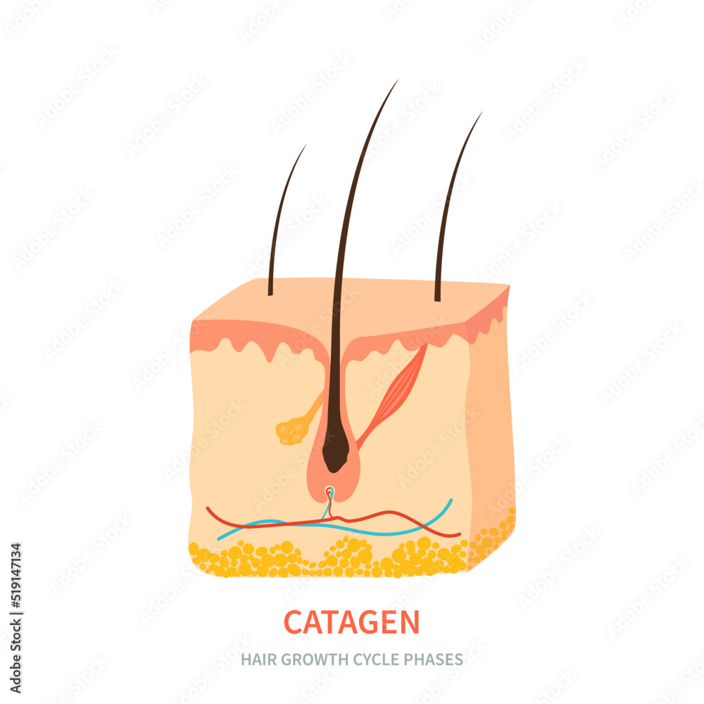 Hair follicle in catagen phase shown in skin cross-section. Hair growth ...