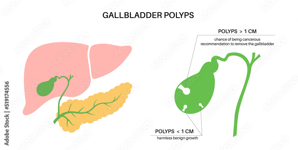 Póster Gallbladder polyp anatomy – Cuadro para Pared | Posters.es
