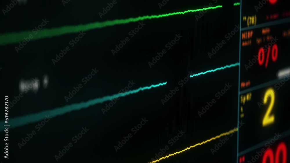 Pulse test graph identifies the patients death in the emergency ward ...
