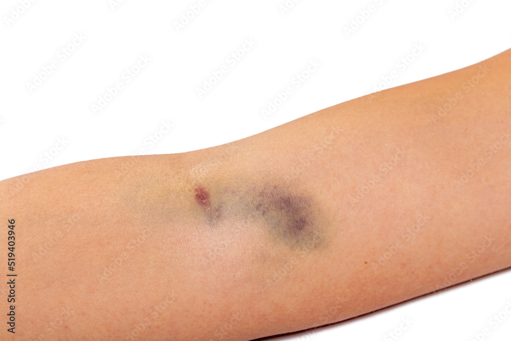 Big bruise on his arm after intravenous injection Stock Photo | Adobe Stock
