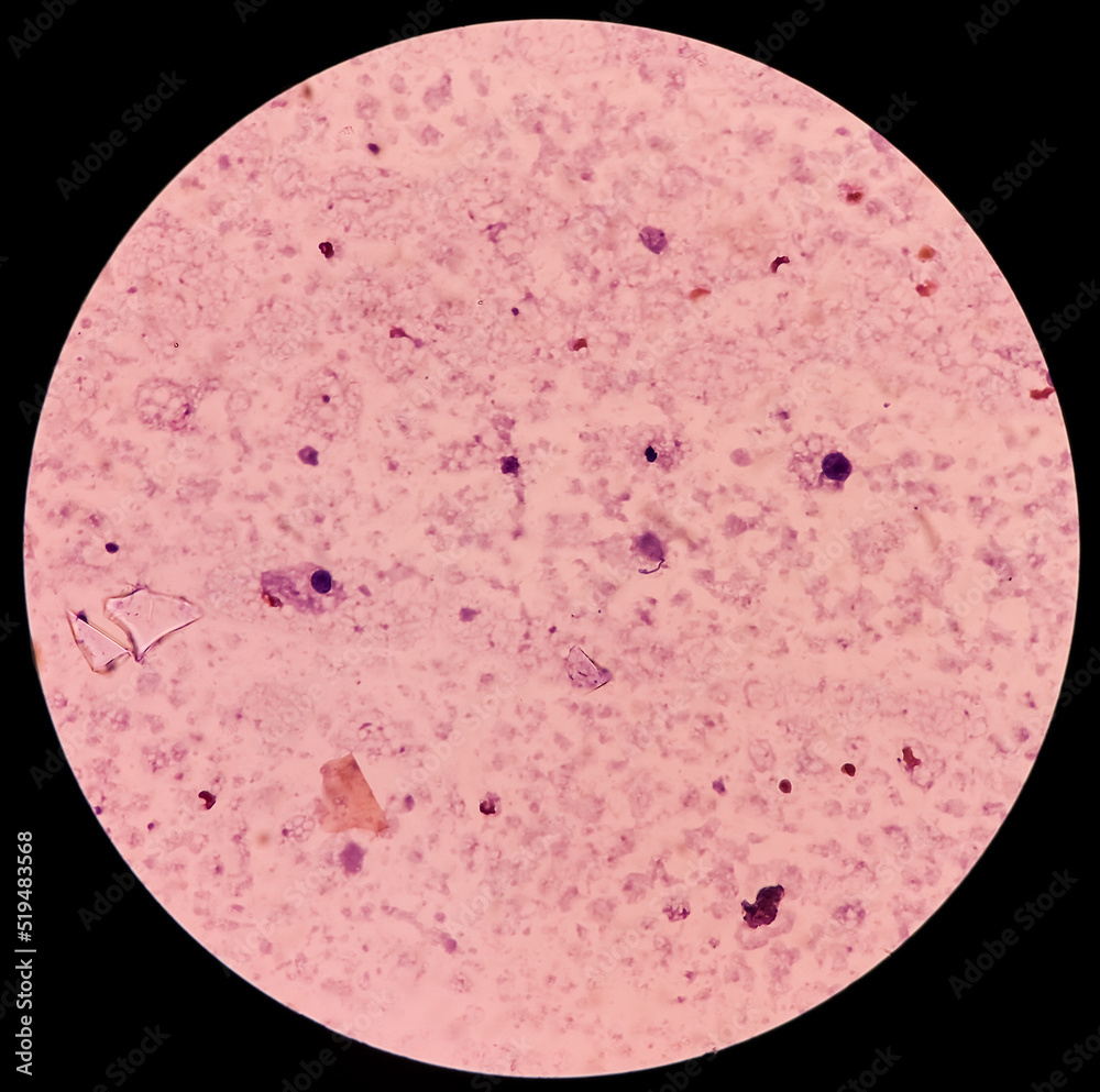 Breast lump(FNA cytology): Galactocele. Microscopic show foamy ...