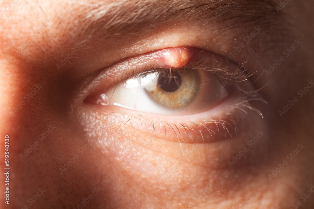 Close up picture of female patient's infected eye. Hordeolum on upper ...