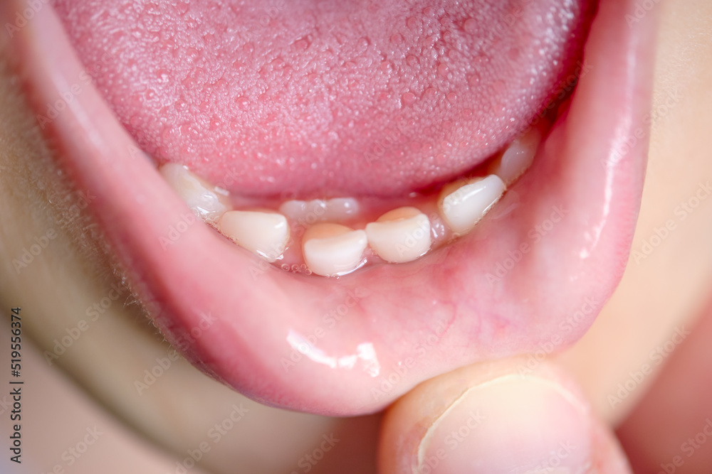 Open mouth of a child with milk teeth. Teeth in two rows. Shark tooth ...