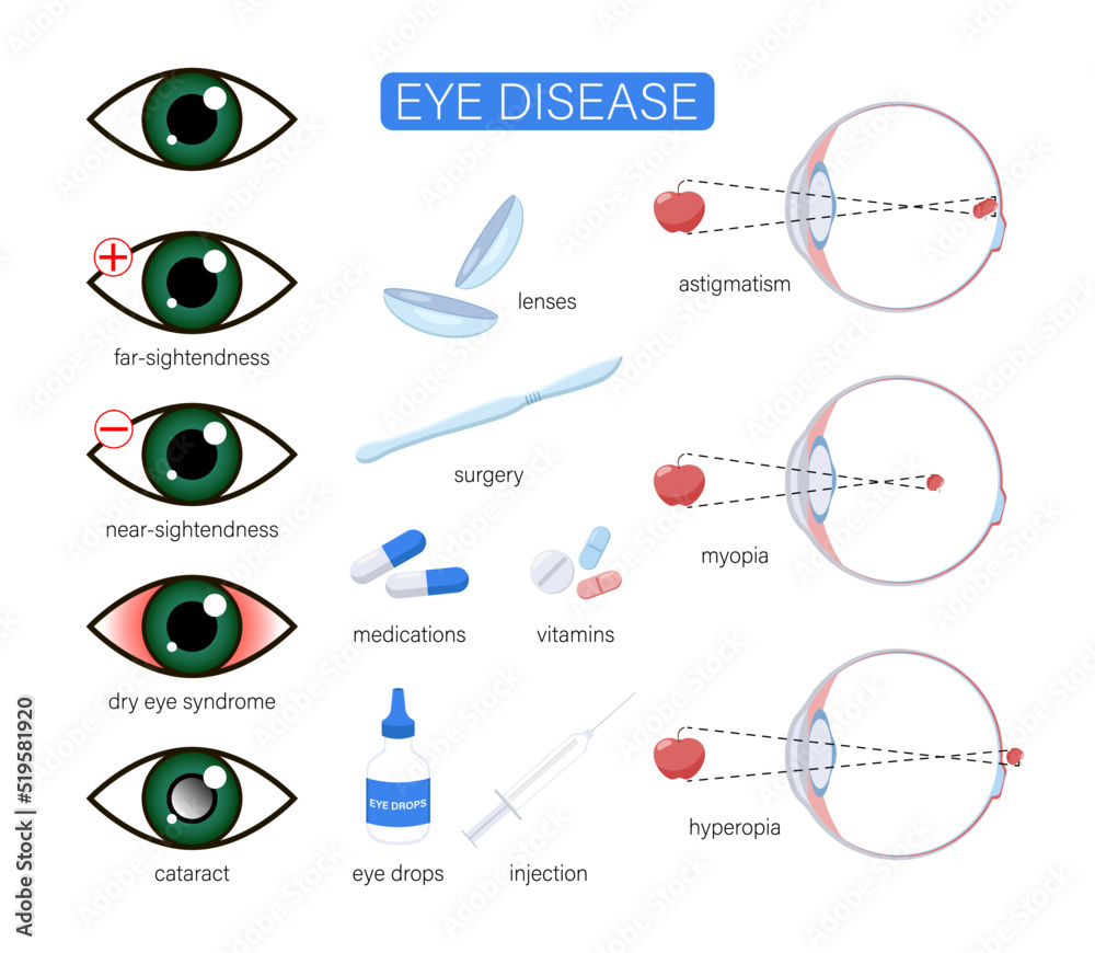 Eye diseases or disorder cartoon illustration set. Astigmatism, myopia ...