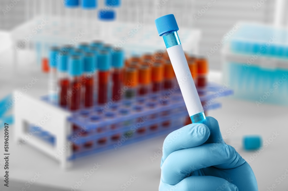 Blood sample tube for virus test. It is also known as the Moneypox ...