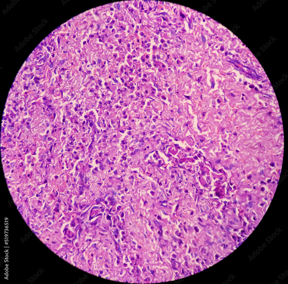 Gartner's duct cyst(biopsy): Microscopic image show cyst wall, composed ...