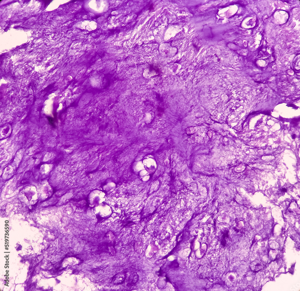 Microphotograph of bone tumor, Enchondroma, show bony tissue features ...