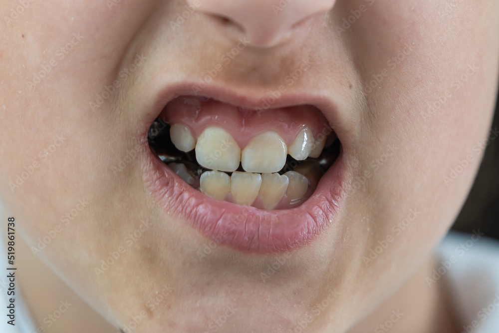 Foto de Adult permanent teeth coming in front of the child baby teeth ...