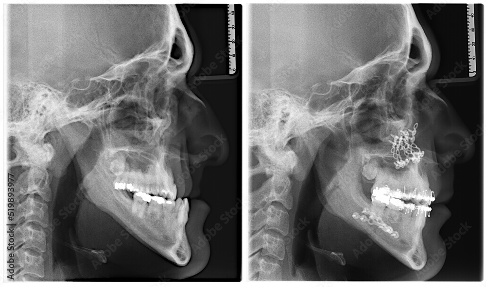 Foto de x-ray image from a man before and after an orthognathic surgery ...