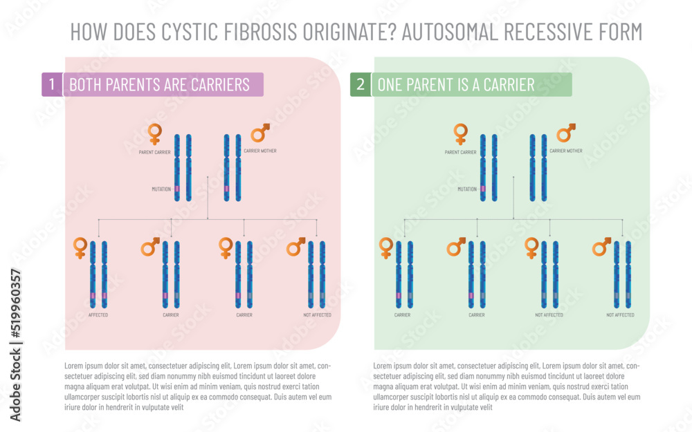 How does cystic fibrosis originate? autosomal recessive form Stock ...